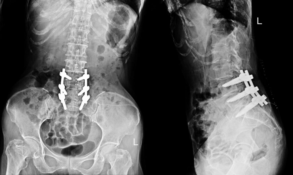 Lower Lumbar Fusion Lower Lumbar Fusion